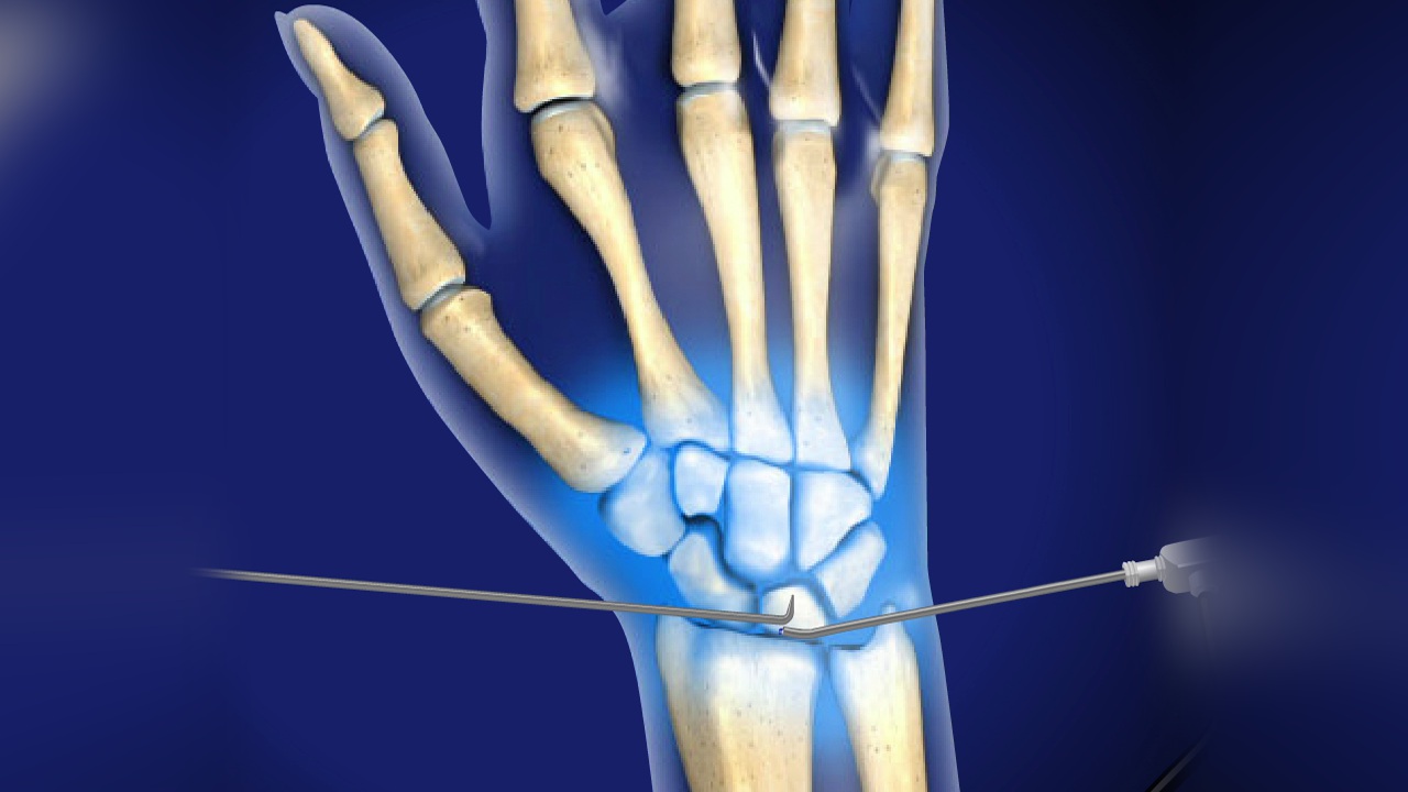 Wrist Arthroscopy with London's Expert, Dr. Shehab Jabir | S J Plastic ...